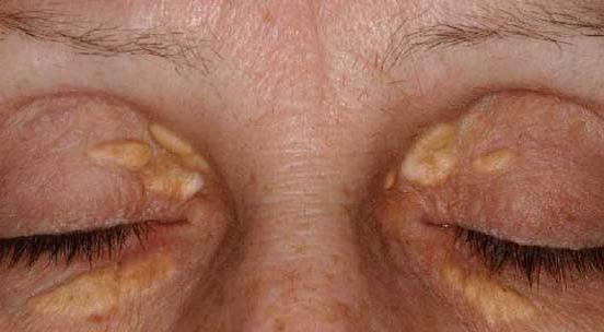 XANTHELASMA Optometry Today XANTHELASMA Optometry Today